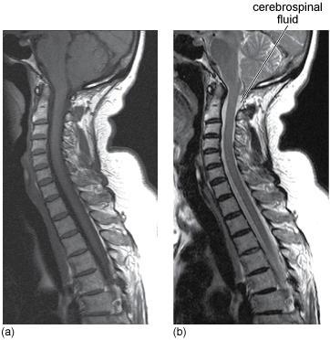 Metals in medicine: T1- and T2-weighted images | OpenLearn - Open ...