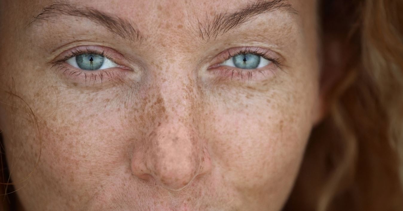 Melanoma: an emerging concern | OpenLearn - Open University