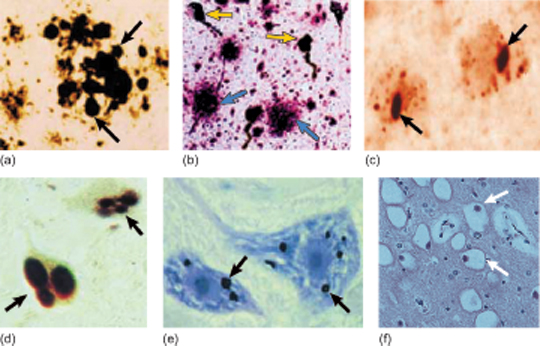 Introduction to histopathology: Figure 12 Protein aggregates in brain ...