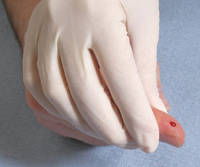 Diabetes complications - OpenLearn - Open University