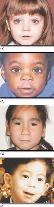 Alcohol and human health: 1.5 Fetal alcohol syndrome - OpenLearn - Open ...