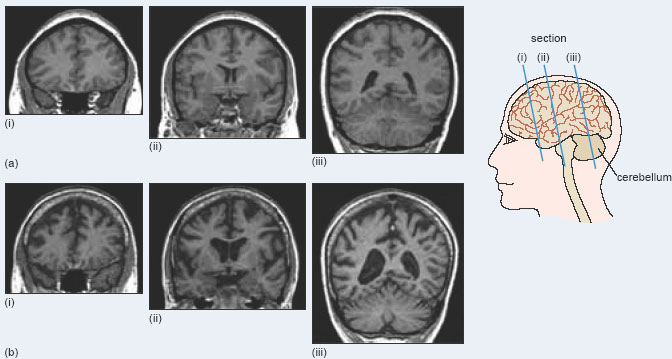 Alcohol and human health: Figure 6 MRI (magnetic resonance imaging ...