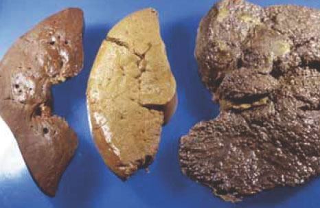 Alcohol and human health: 1.3.1 Alcoholic liver disease - OpenLearn ...